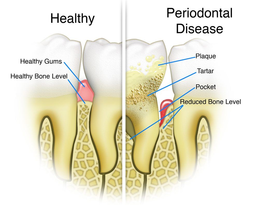 What is Periodontal Disease? » Dental Clinic in Ottawa, ON - Kent ...